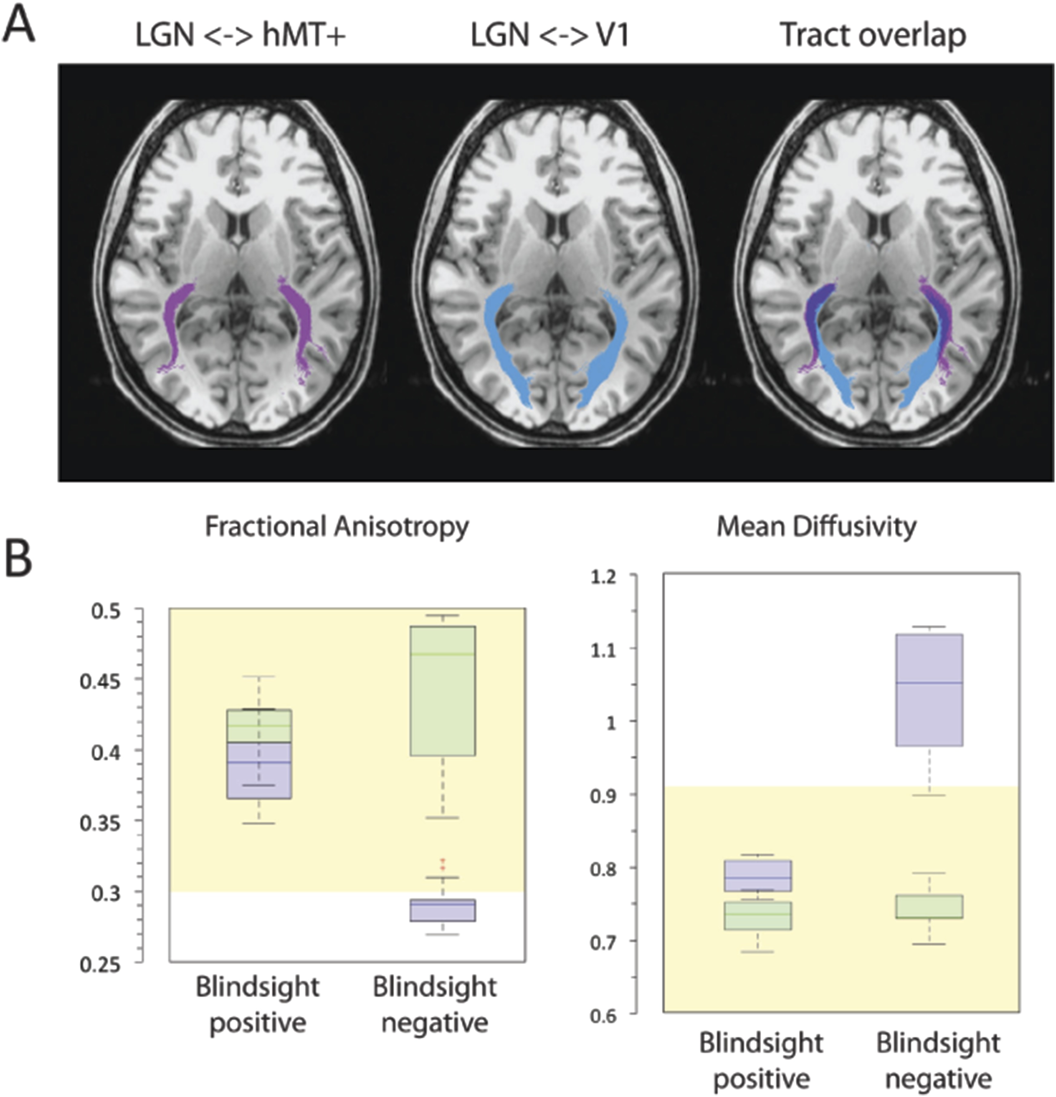 Human blindsight is mediated by an intact geniculo-extrastriate pathway ...